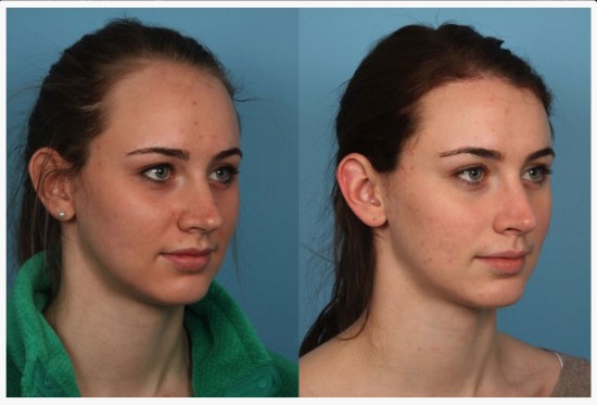 Enhance Your Appearance With Hairline Lowering |Dr. Sidle